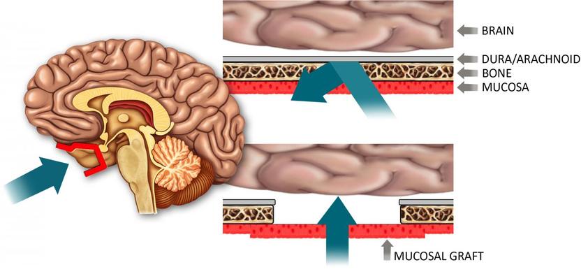Drug delivery technique to bypass blood-brain barrier